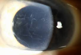 Epithelial Basement Membrane Disorder Tulsa | OMEG