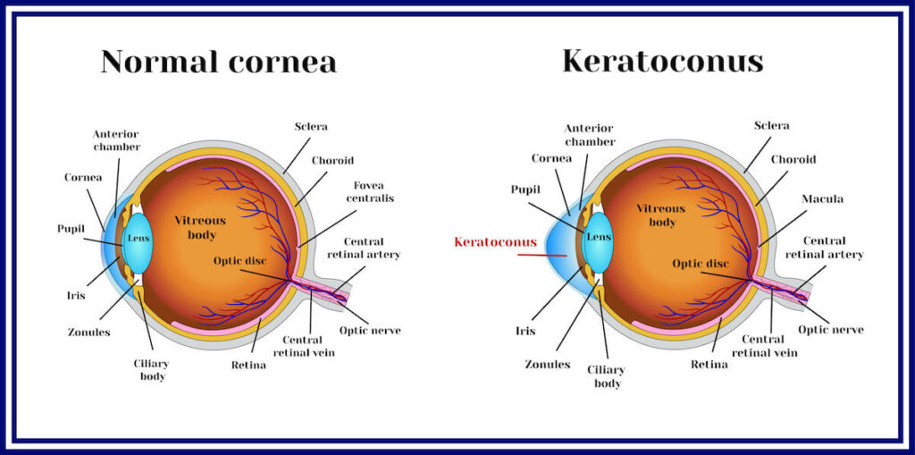 Keratoconus Tulsa | Corneal Transplant Bartlesville
